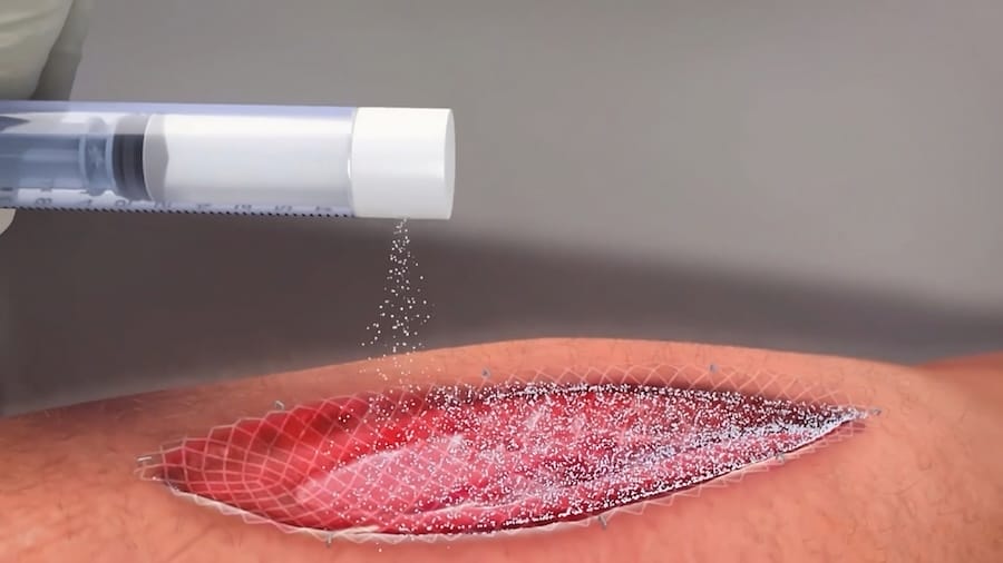 Dr. Kevin Foster Advances Burn Healing With Spray-On Skin